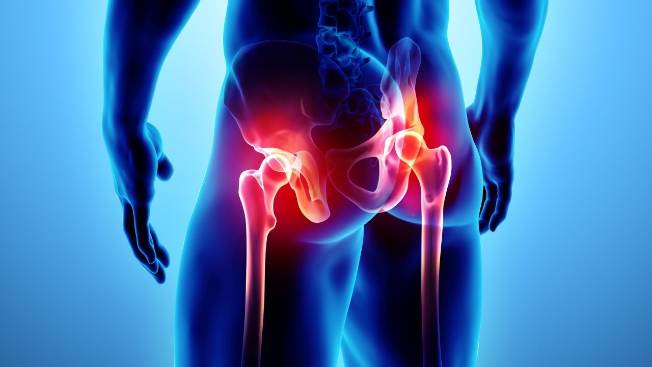 Kalça Problemleri Belirtileri - Ortopedi ve Travmatoloji