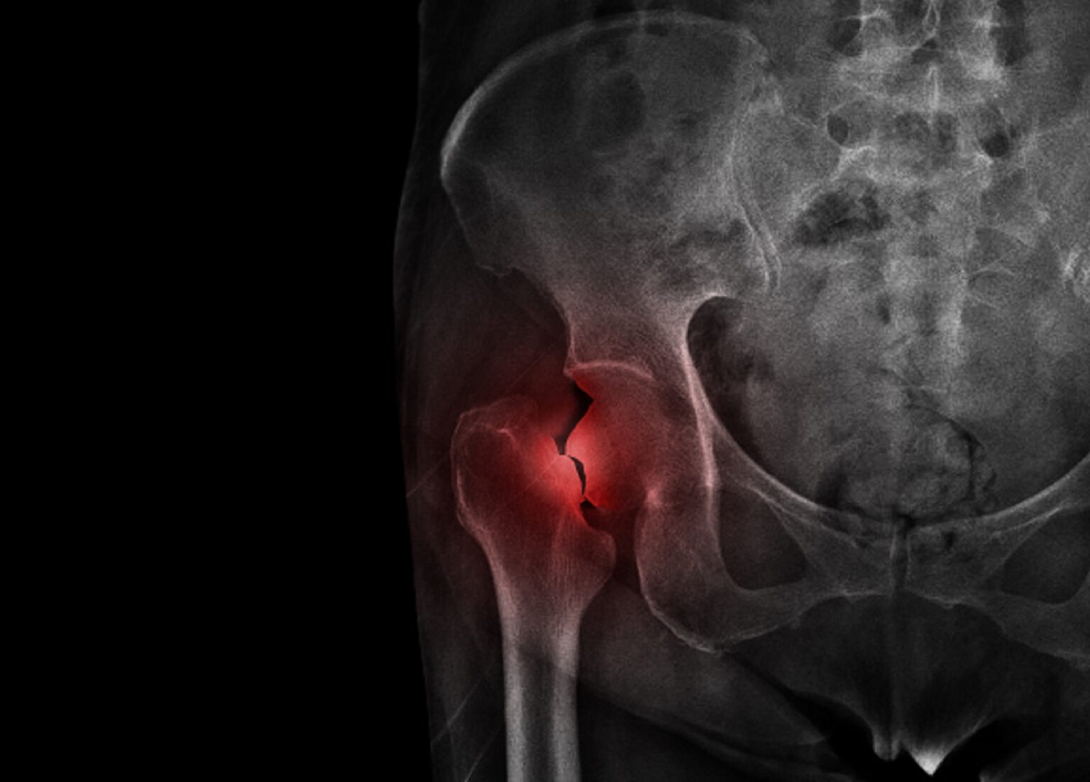 Kalça Kırığı Nedir? - Prof. Dr. Hasan Hilmi Muratlı